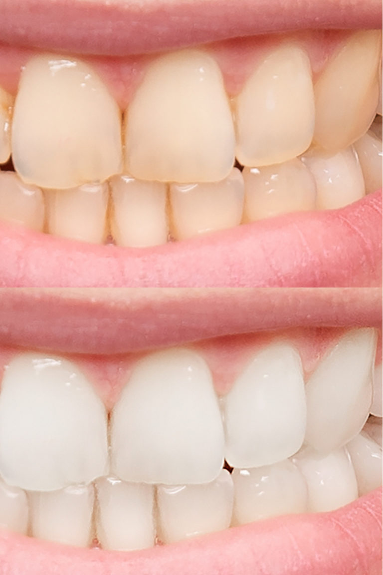 Whiten your teeth with this simple hack and almost no effort